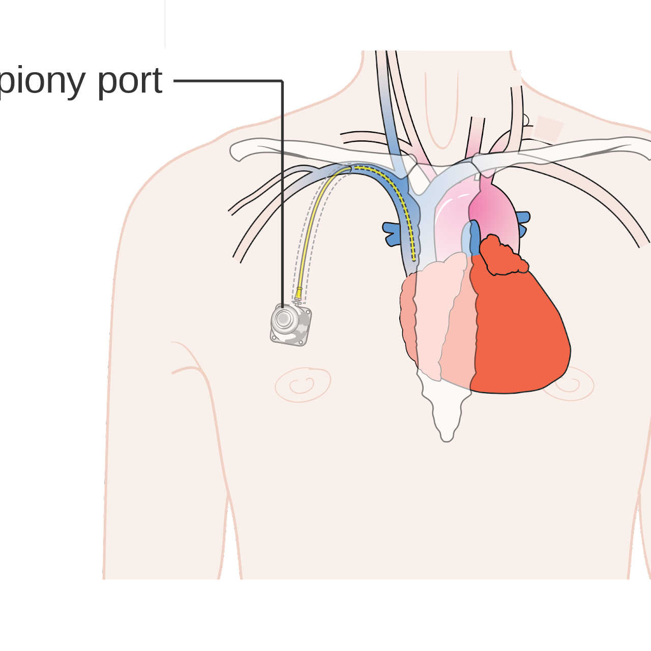 Obsługa portu naczyniowego – Gabinet Leczenia Ran i Podologii | mgr ...